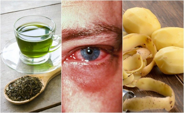 8 Best Home Remedies for Pink Eye - Step To Health