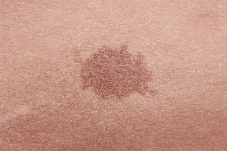 Skin Spots and What Causes Them - Step To Health