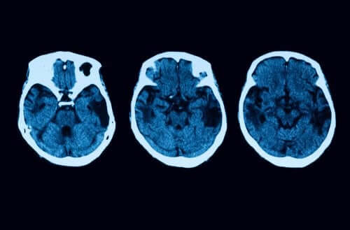 Posterior Cortical Atrophy Diagnosis and Treatment - Step To Health