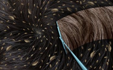 How to Get Rid of Nits Quickly - Step To Health