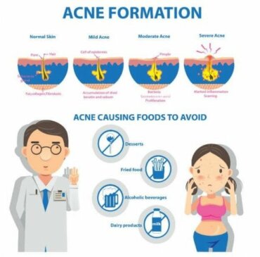 Acne Conglobata: Causes and Symptoms - Step To Health
