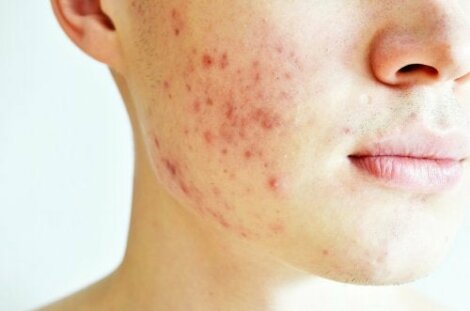 - Cystic Acne is The Most Aggressive Variant of Acne
