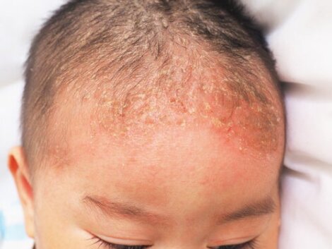 What's Seborrheic Dermatitis in Infants? - Step To Health